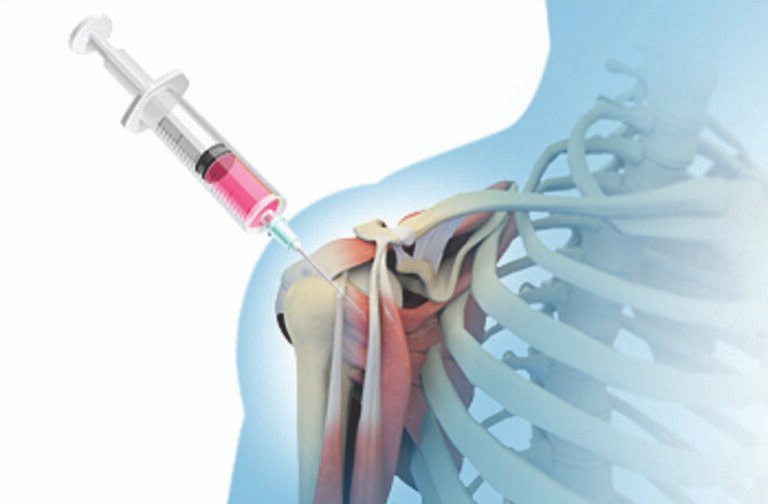 Bone Marrow Concentrate Injection for Cartilage Defects – Shankara ...