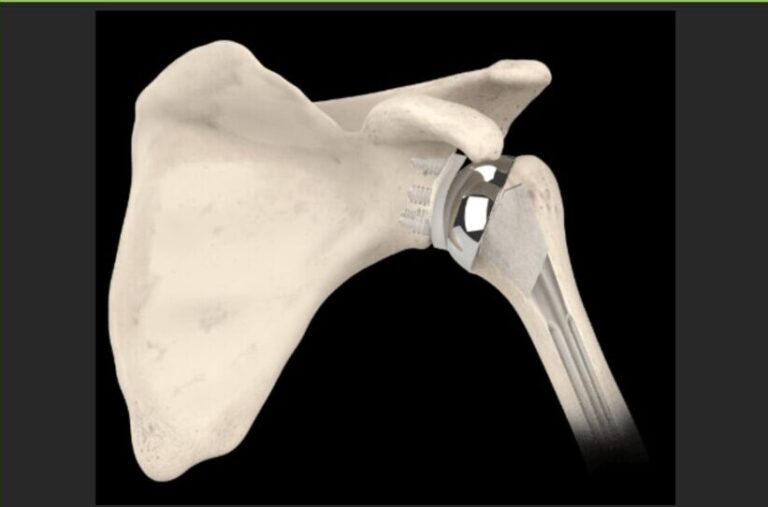 Hemi/Total Shoulder Replacement - Shankara Ortho Clinic - Dr ...